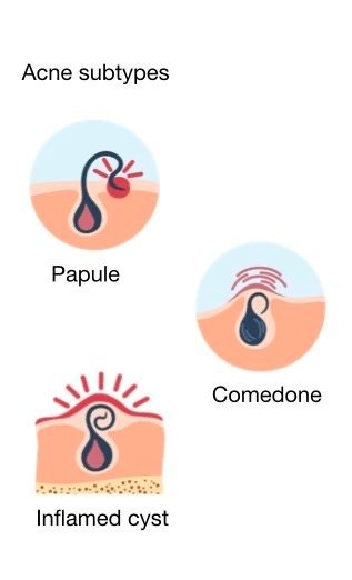 A 3-Step Skincare Routine for Acne: A Revolutionary Approach - Science ...